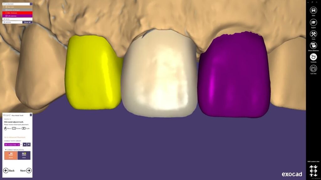 Exocad Explained | Exocad Elite